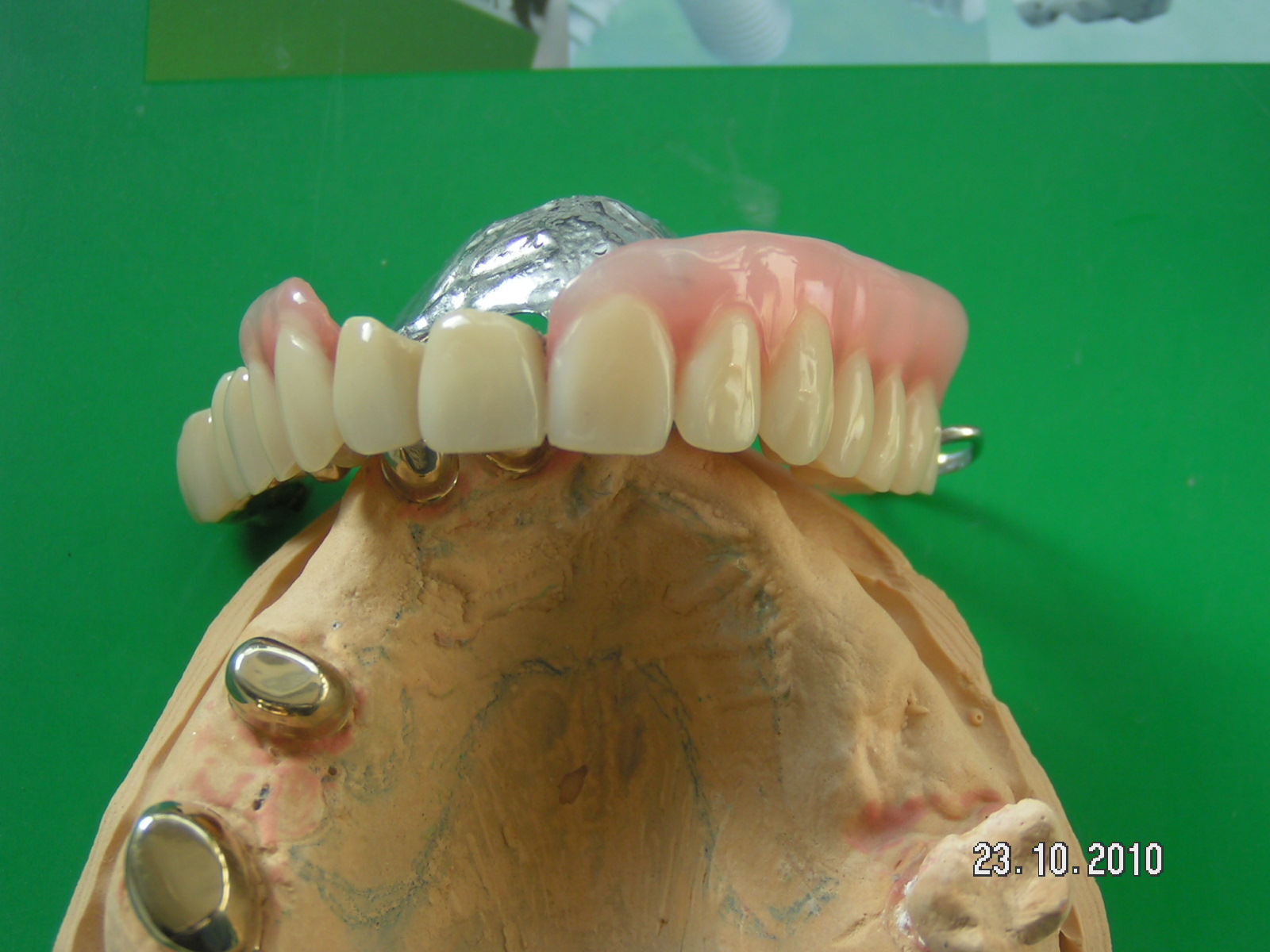 Geschiebe- Teleskop- Prothesen - combident.de